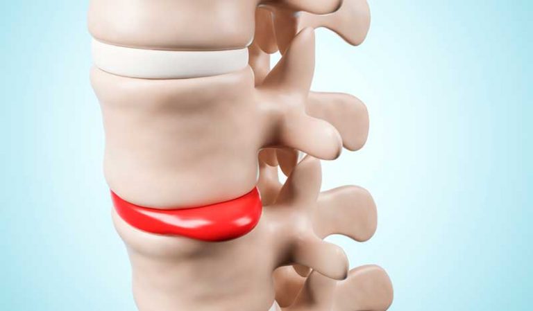 What Causes Spinal Disc Herniations Sunset Chiropractic And Wellness