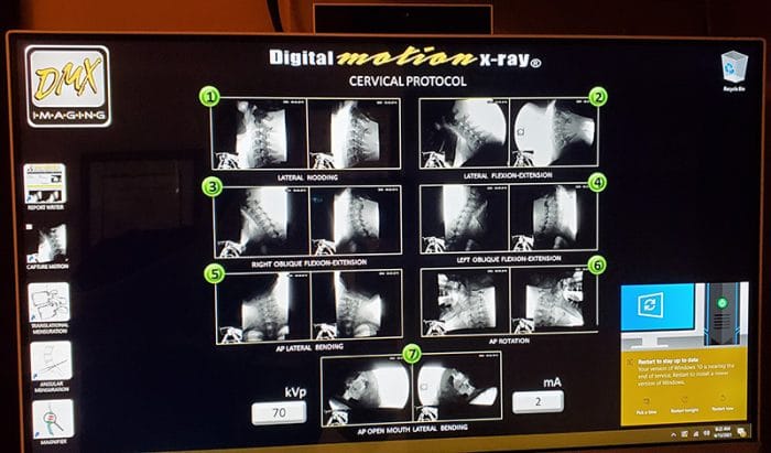 (DMX) Digital Motion X-ray detects ligament and spinal injuries that go ...