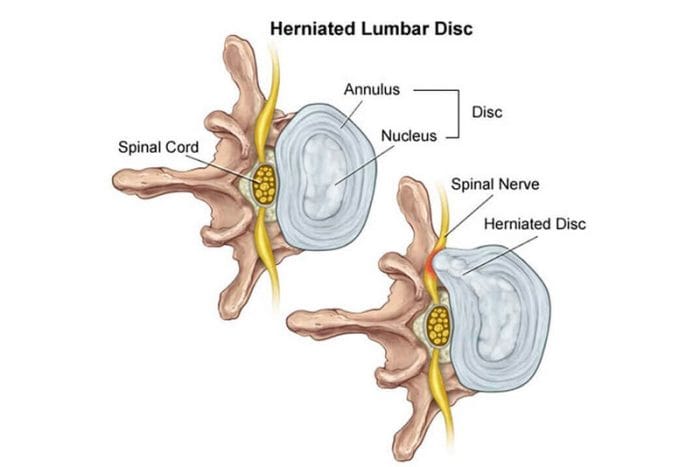 What Causes Spinal Disc Damage Herniations, Bulges, Protrusions ...