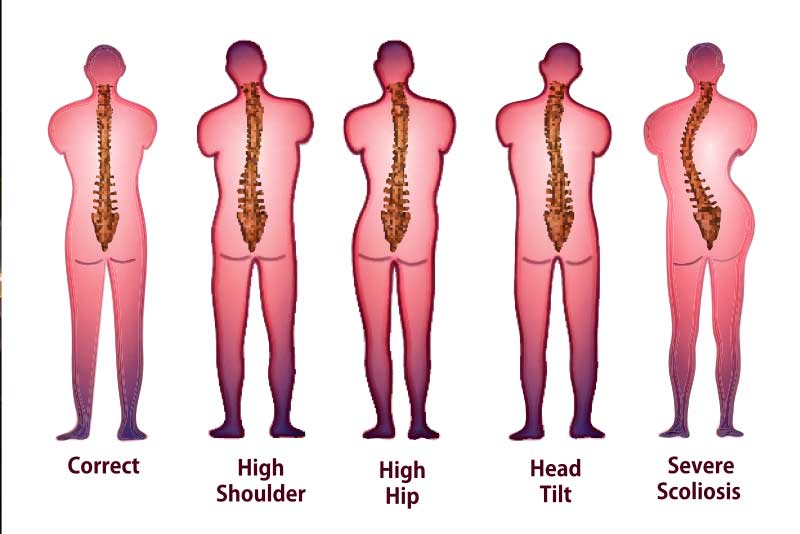 Sunset Chiropractic & Wellness Research Review: ¿Asociación entre la ... Sunset Chiropractic & Wellness Research Review: ¿Asociación entre la ...